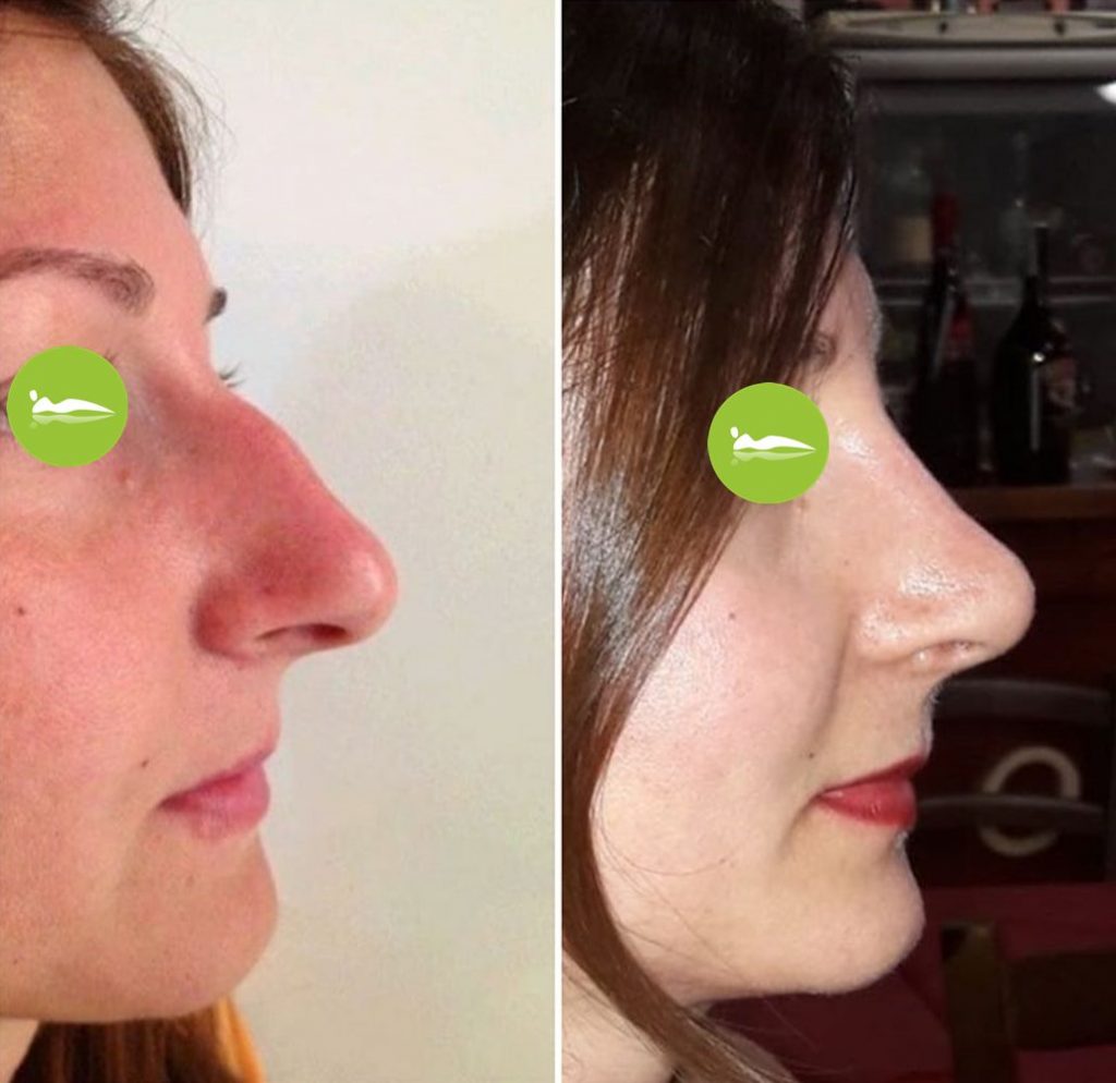 Rinoplastica - Costi, risultati, informazioni - Chirurgia estetica naso