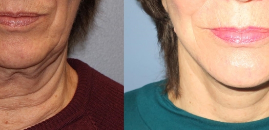 Lifting del collo | Chirurgia estetica e plastica, Medicina estetica ...