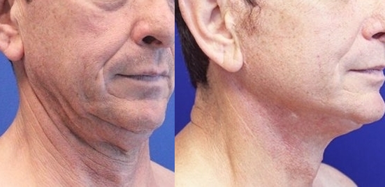 Lifting del collo | Chirurgia estetica e plastica, Medicina estetica ...