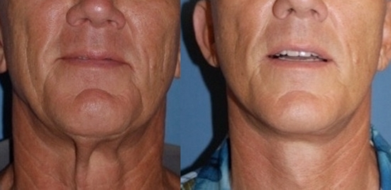 Lifting del collo | Chirurgia estetica e plastica, Medicina estetica ...